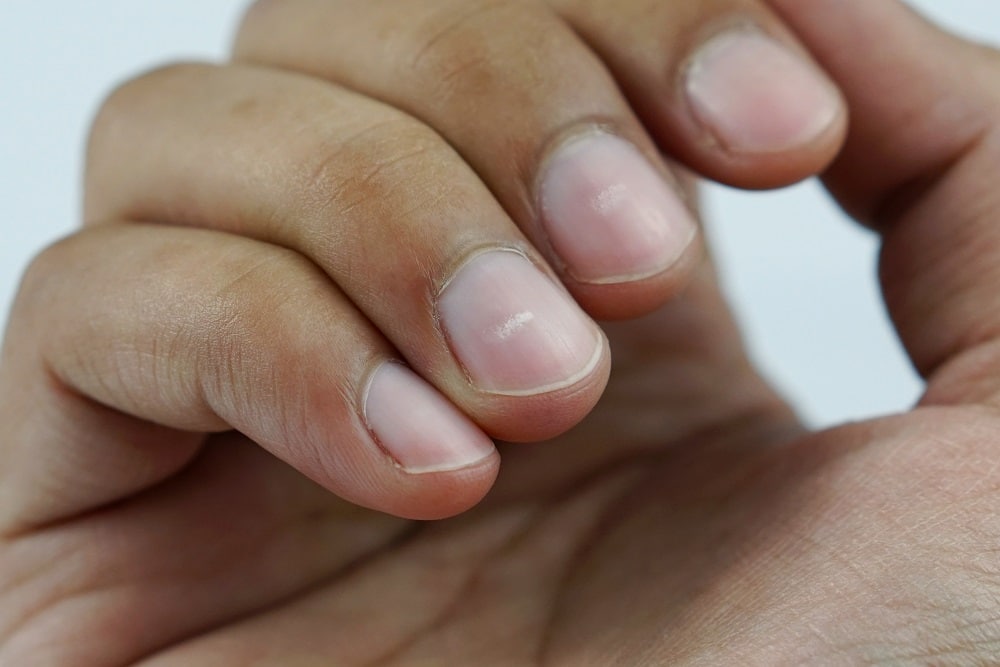 Nail Health | What Do White Marks On Your Nails Mean?